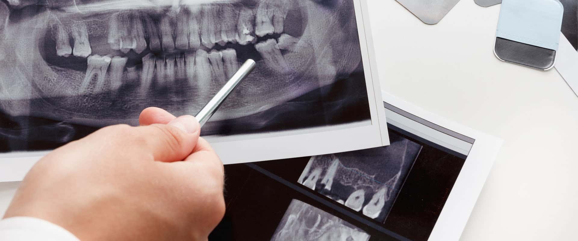 Bone Grafting & Socket Protection - Vestal Dental